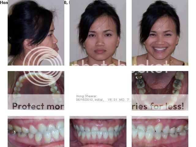 Lower Jaw Surgery w/ Orthodontic treatment for Lower Jaw too forward ...